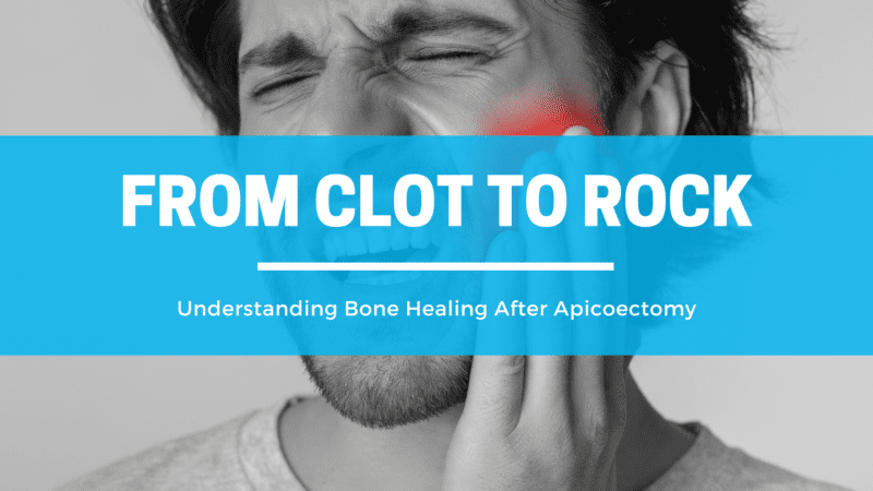 Learning Center | Understanding Bone Healing After Apicoectomy