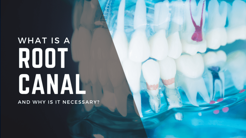 Learning Center | What Is A Root Canal And Why Is It Necessary?