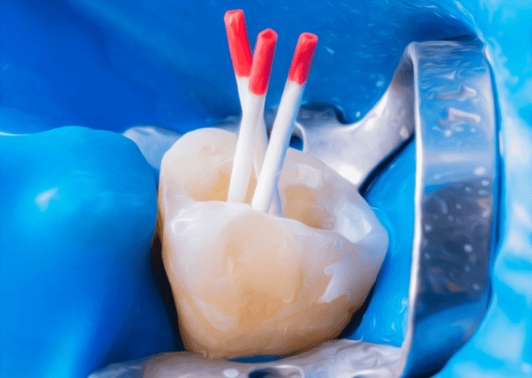 Uncover the Truth: Debunking Common Root Canal Myths | Eastern Idaho ...