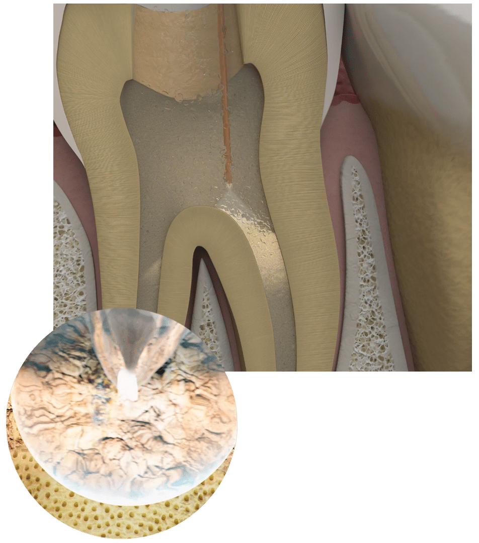 Root Canal Specialists in ID & WY | Eastern Idaho Endodontics
