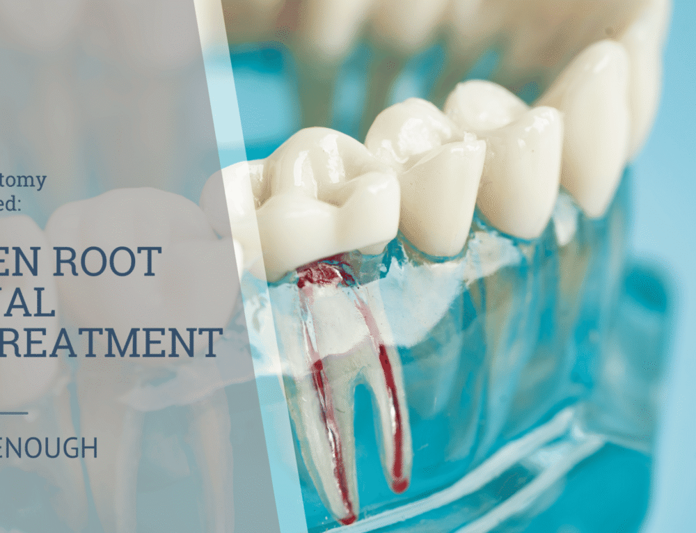 Complete Recovery Guide After an Apicoectomy Procedure