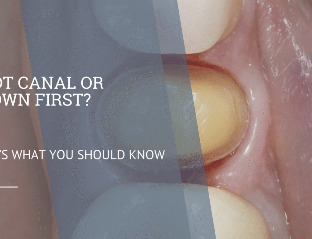 Step-by-Step Guide to How Root Canals Are Performed - Eastern Idaho ...