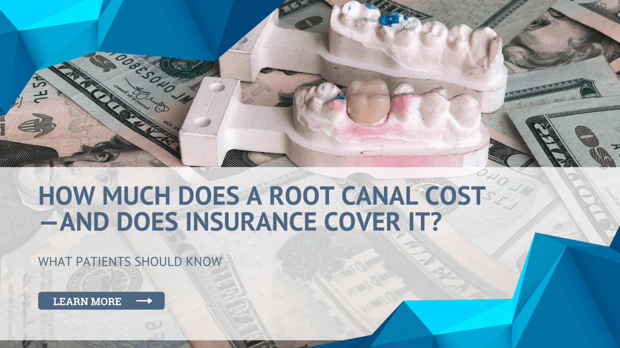 Crown or No Crown? What Happens After a Root Canal - Eastern Idaho ...
