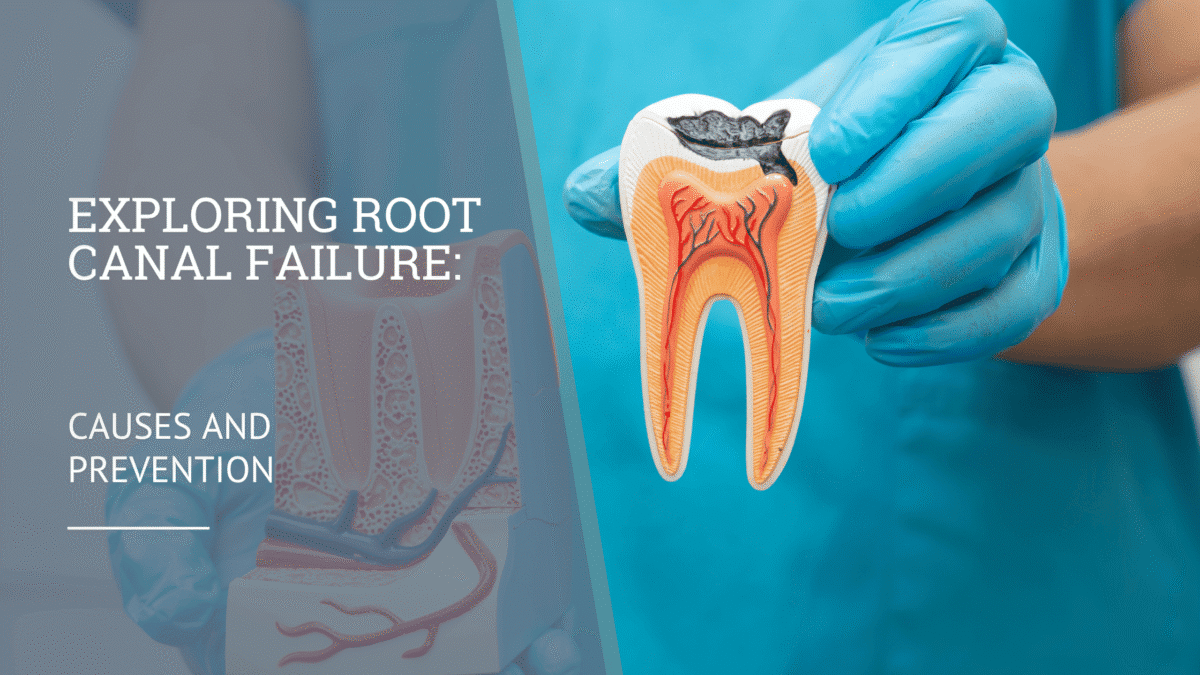Exploring Root Canal Failure: Causes and Prevention - Eastern Idaho ...