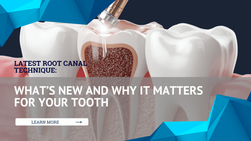 Latest Root Canal Technique: Modern, Comfortable Treatment
